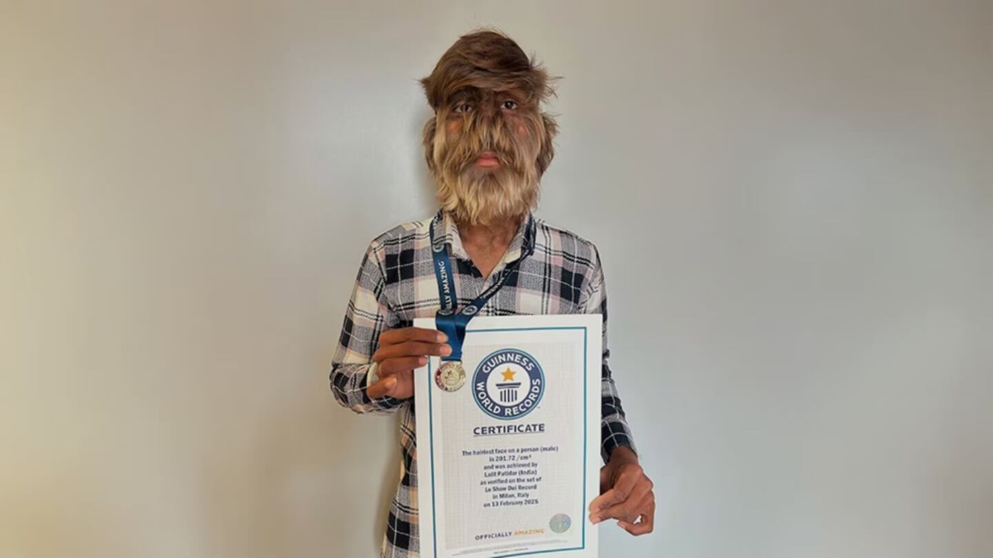 La condición genética de Lalit Patidar, el hombre conel rostro más peludo del mundo – FayerWayer